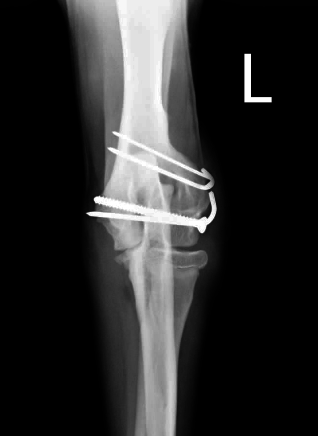 ARTROVET: Fractura del proceso lateral del cóndilo humeral