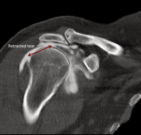 Shoulder and Elbow Surgery: Three cases of rotator cuff surgery. Mini ...