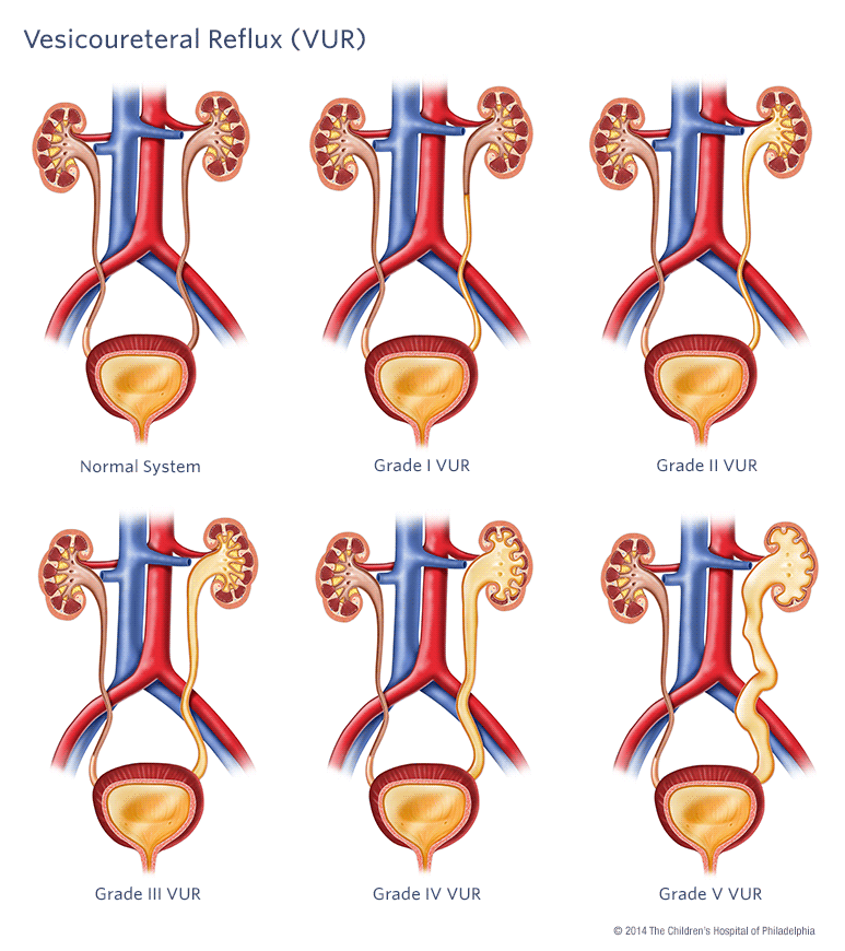 Diverging Lives: Vesicoureteral Reflux (or VUR)