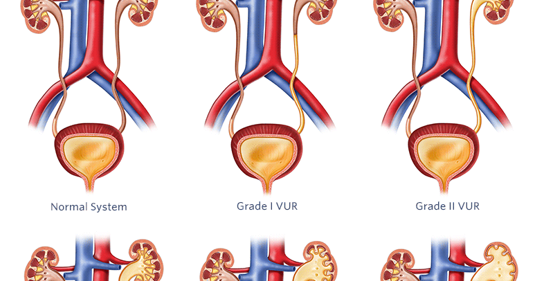 Diverging Lives: Vesicoureteral Reflux (or VUR)