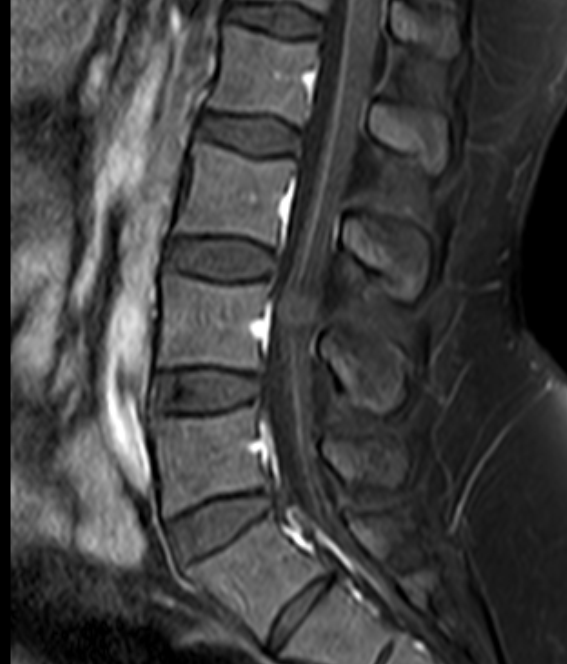 Cauda Equina Tumour-Differentials - Sumer's Radiology Blog