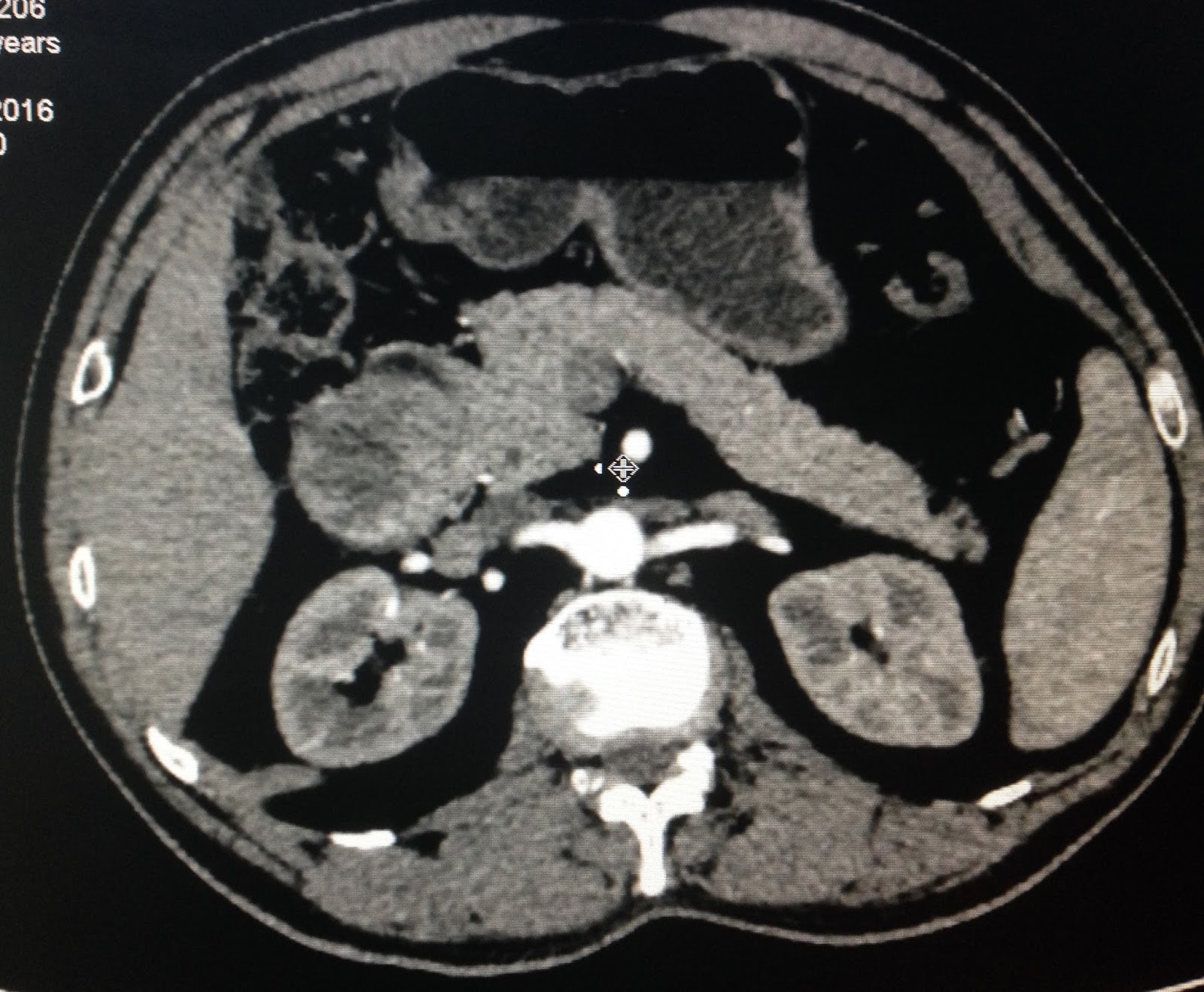 VIETNAMESE MEDIC ULTRASOUND: CASE 369: DUODENUM TUMOR, Dr PHAN THANH ...