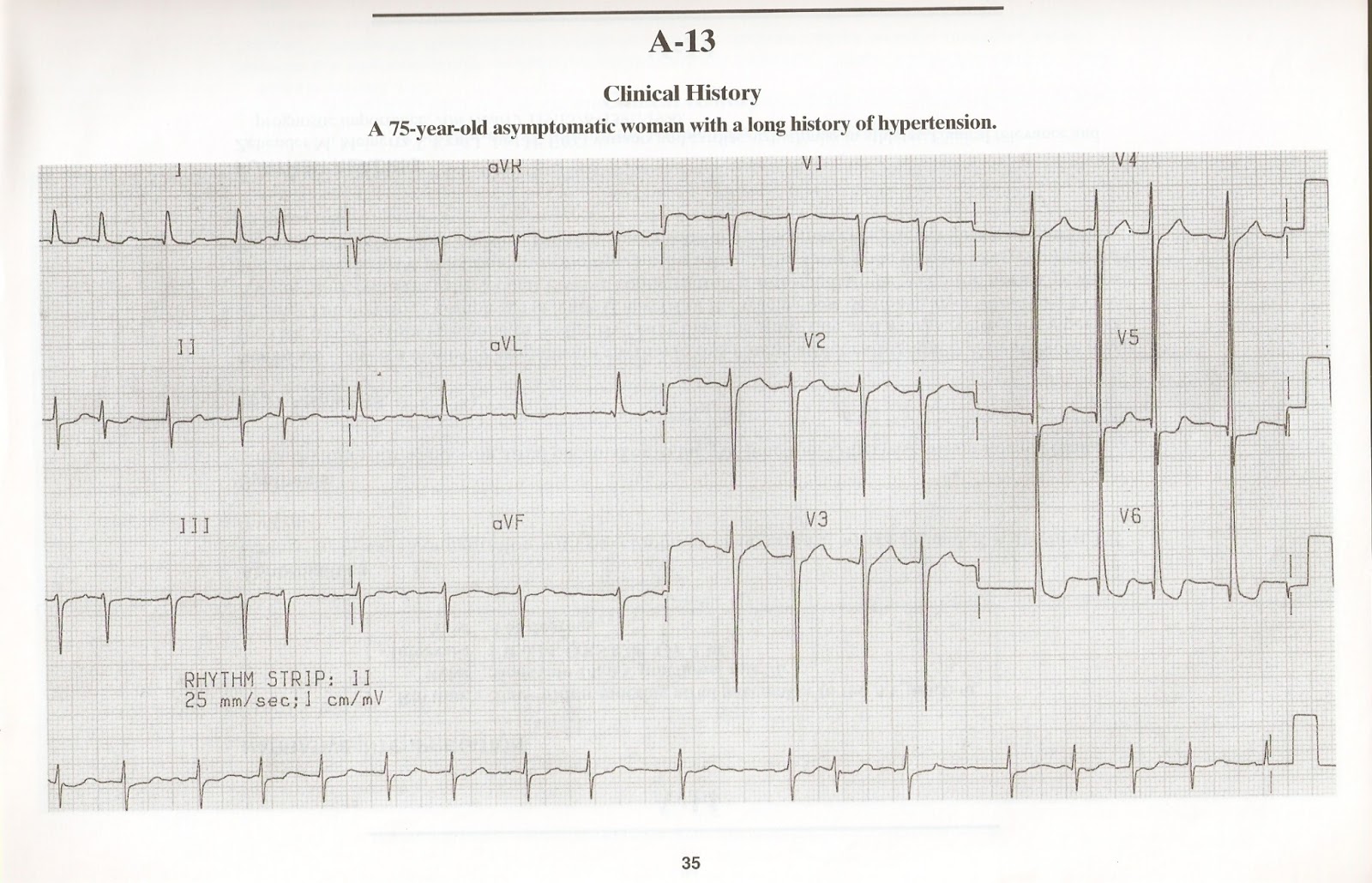 MBBS Medicine (Humanity First): ECG Interpretations