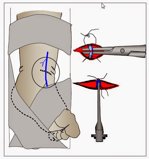 Kesehatan dan Keperawatan: Prosedur Intravena