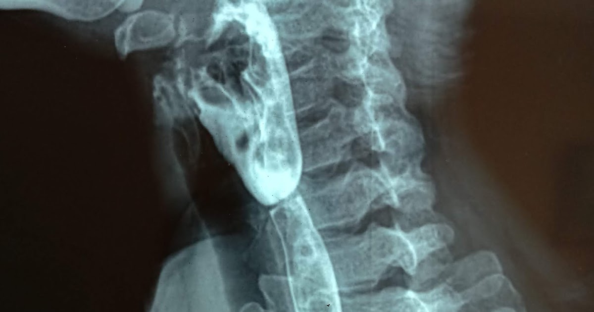 Imagenes en gastro: Membrana esofagica