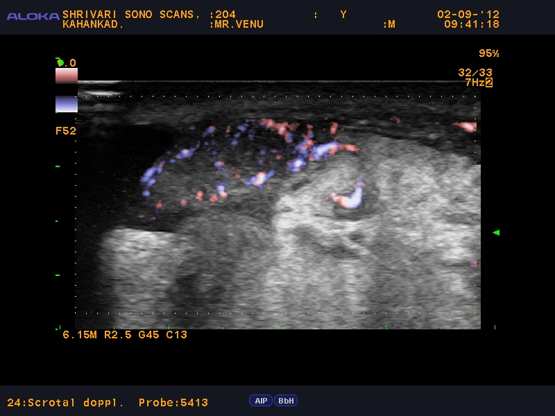 Shrivari Sono Scans: Hrsg imaging scrotum-Images of epididymis in Acute ...