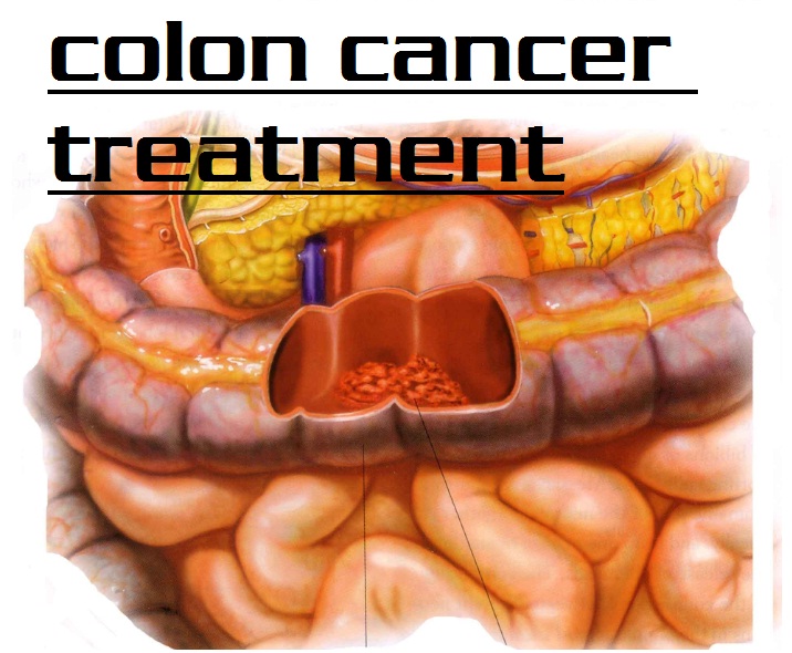 colon cancer info