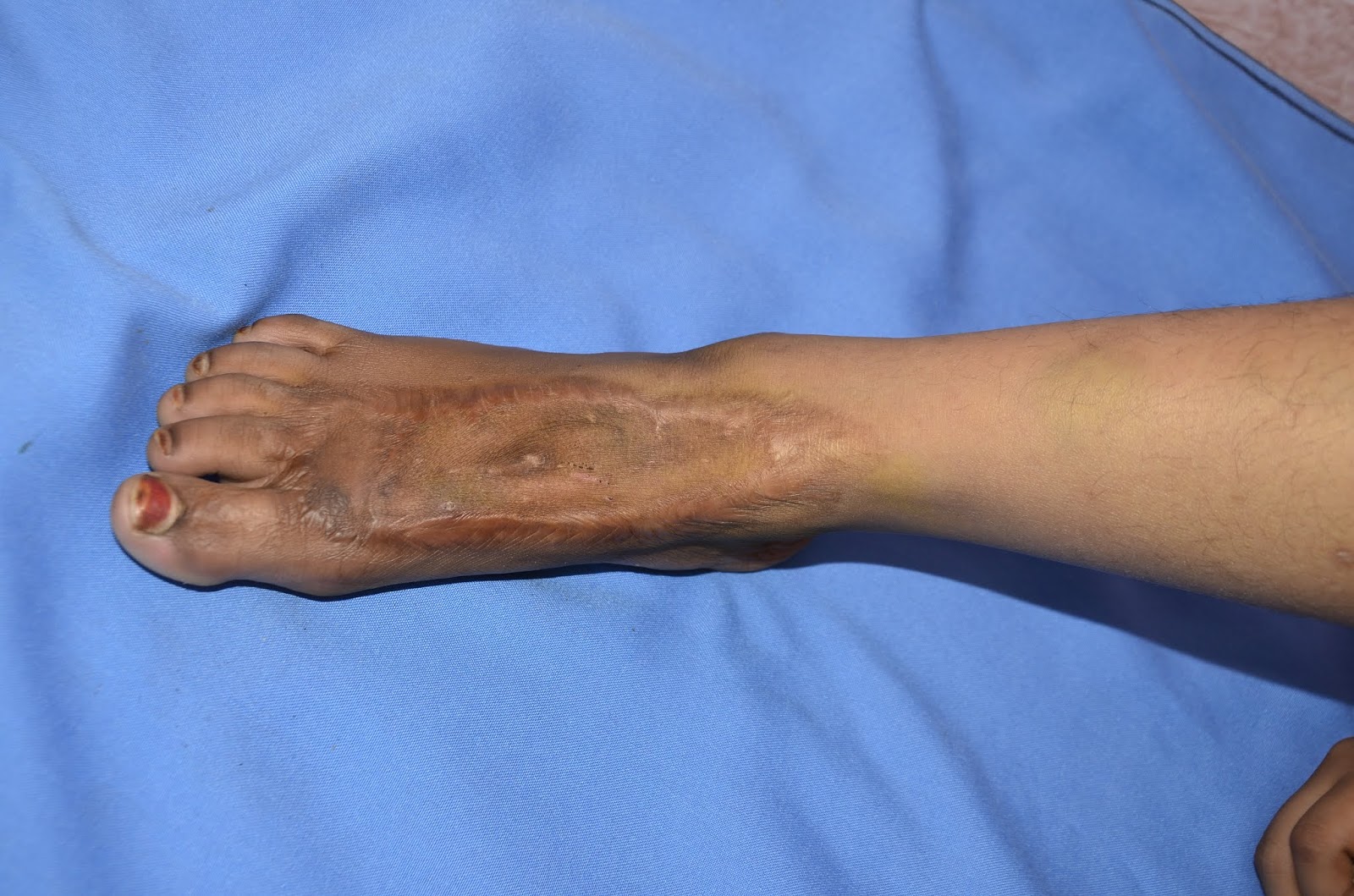 DORSAL COMPOSITE SOFT TISSUE LOSS - CHILD - NEGATIVE PRESSURE WOUND ...