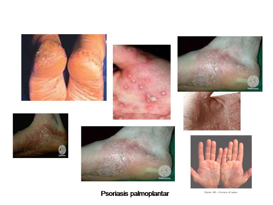 Psoriasis