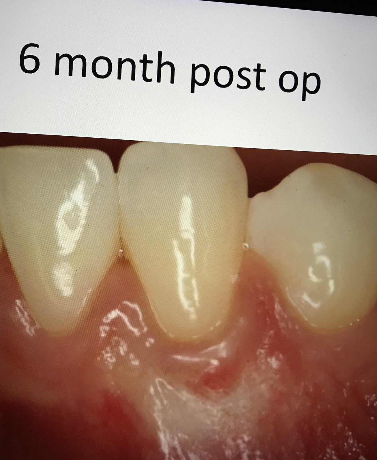 Dental Info: Connective tissue graft from the palate or allograft for ...