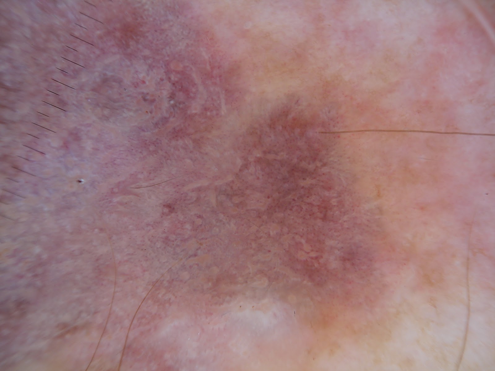 Consultations in Dermatoscopy: Pink and Purple