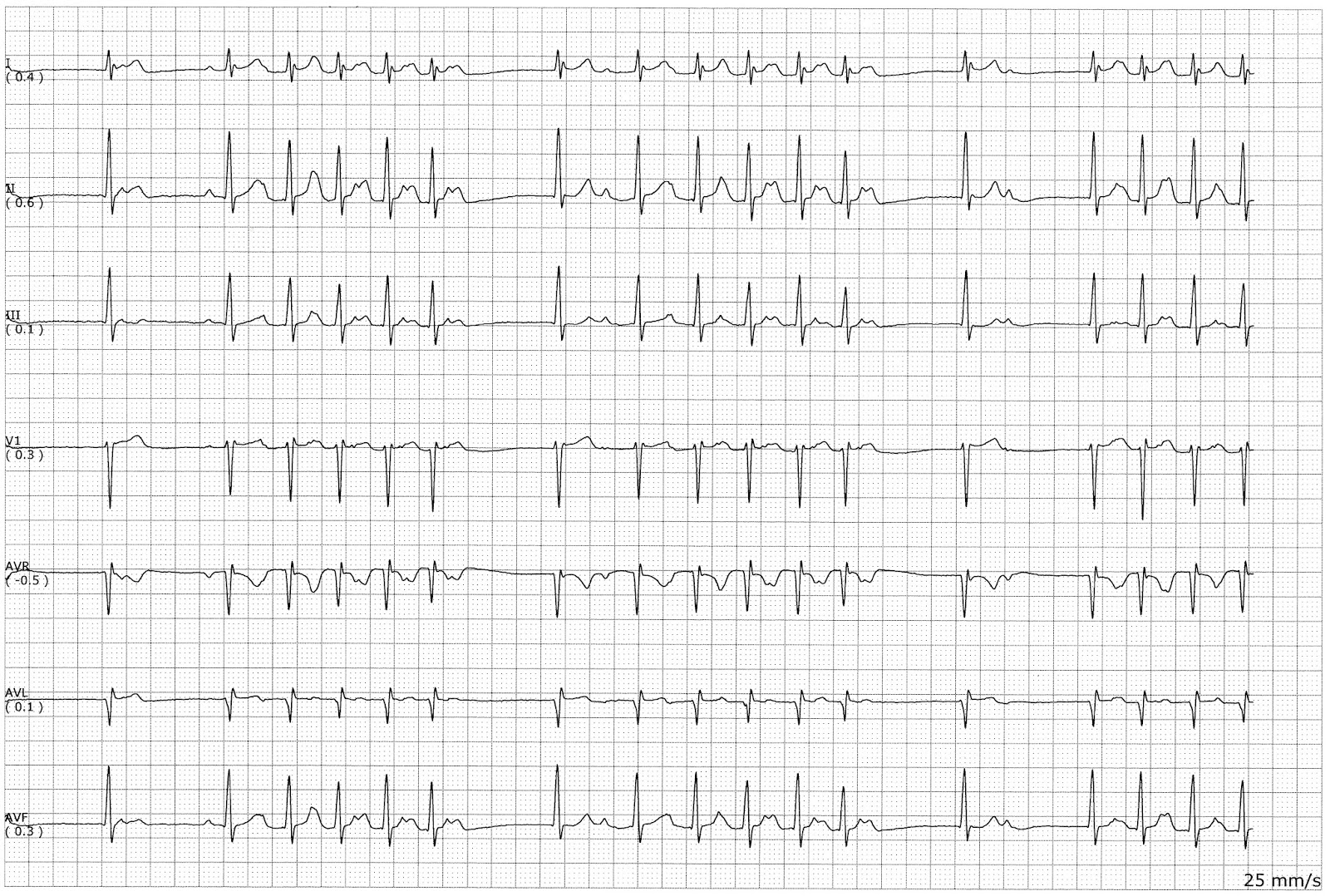 Multiple and Consecutive PACs with Junctional Escape Beats