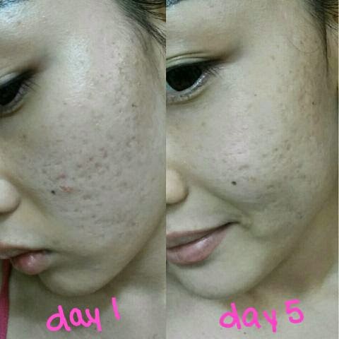 Cushing's Disease: Fading Acne Scars & My ACTH Stimulation Test