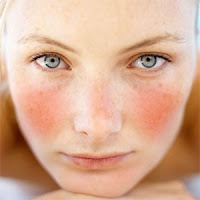 Anti Redness: Typical Red Face Causes That Should Be Avoided