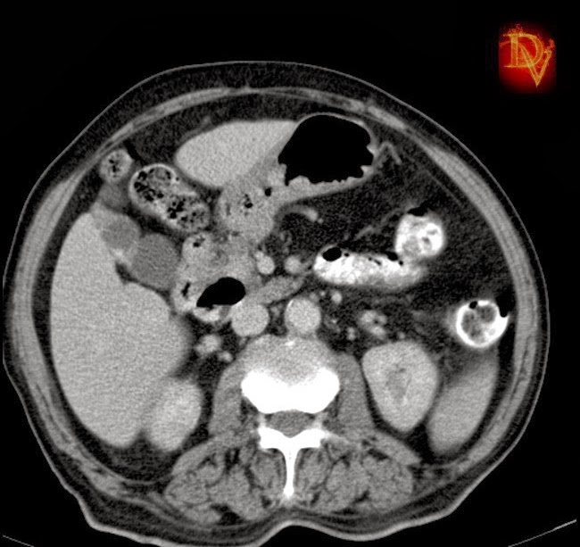Ultimate Radiology : Duodenal Diverticulum - CT sections
