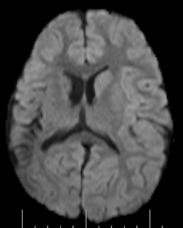 Rasmussen’s encephalitis-MRI - Sumer's Radiology Blog