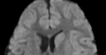 Rasmussen’s encephalitis-MRI - Sumer's Radiology Blog