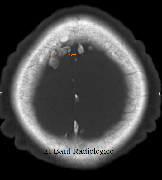 El Baúl Radiológico: CALCIFICACIONES DURALES EN TOMOGRAFÍA ...