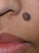 Photos of Moles on Face and Neck ~ How To Remove Moles, Warts, Skin ...