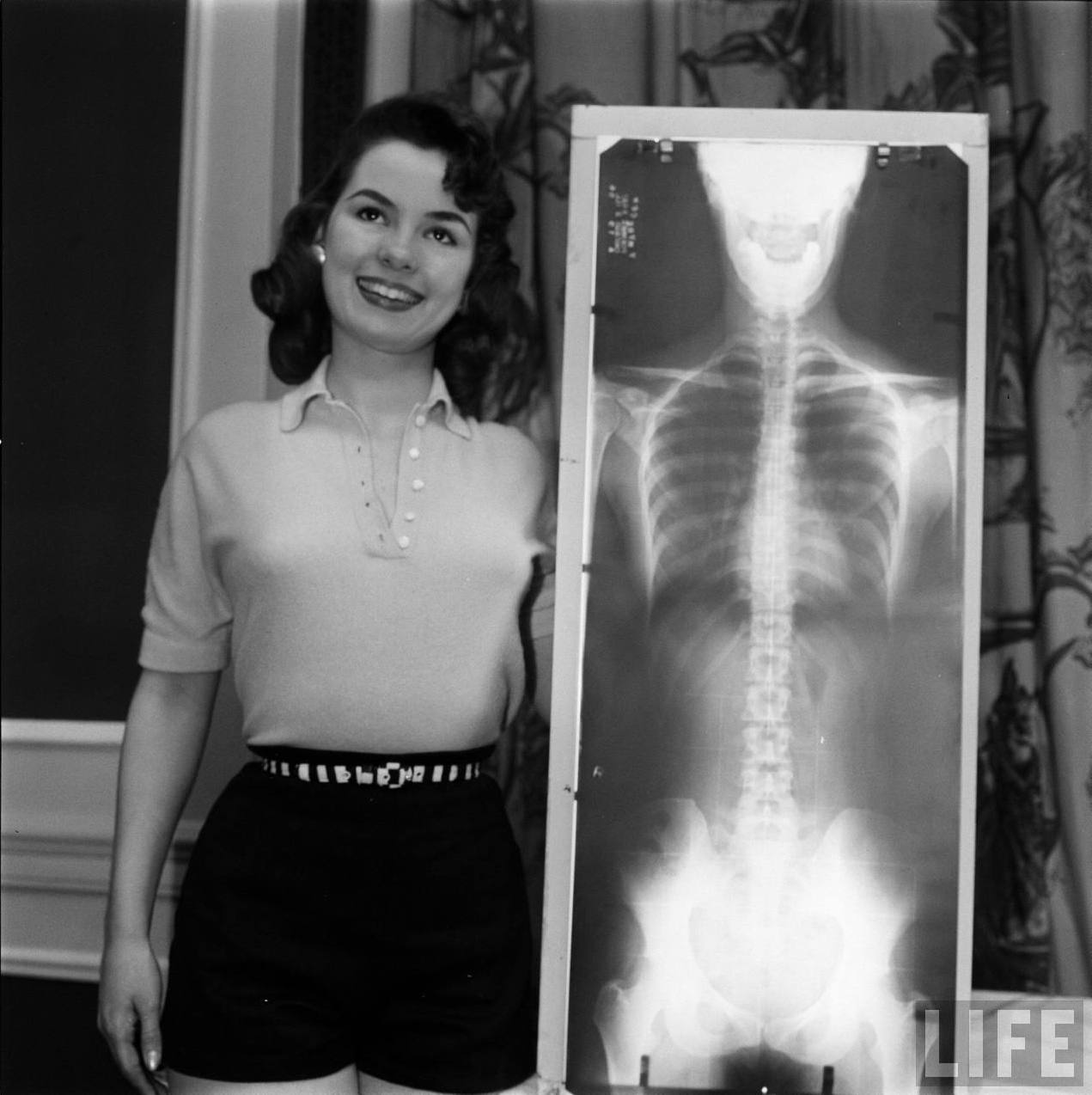 Miss Correct Posture: Pictures From a Chiropractor's Beauty Contest ...