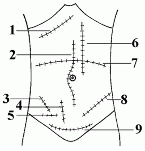 Kolelitiasis (Batu Empedu) ~ Informasi Kedokteran Dan Kesehatan