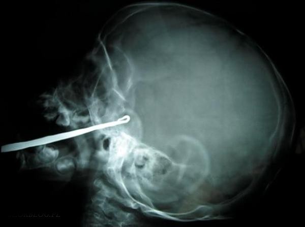 Deformutilation: Disturbing X-Rays