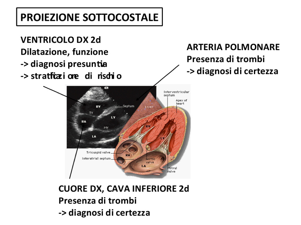 Manuali di Medicina Intensiva: Embolia polmonare - management e terapia ...