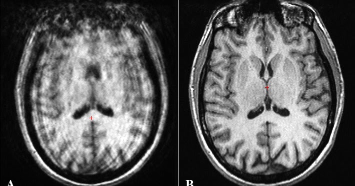 A guide to quantifying head motion in DTI studies | Diffusion Imaging; Introduction, tutorials ...