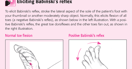 medical student: Babinski sign