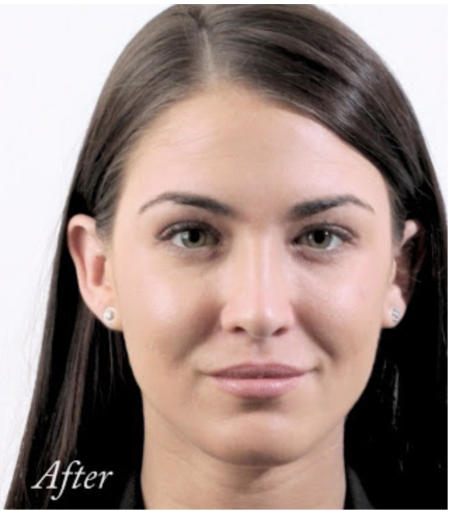 5 Reasons To Start Fillers in Your 30s - The Skin Radar