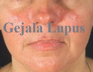 7 Ciri Gejala Penyakit Lupus