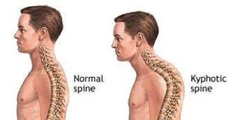 Study Medical Photos: Introduction to Kyphosis