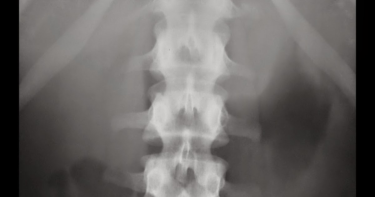 Radiology Archives: Μεταβατικός Oσφυο-Ιερός Σπόνδυλος - Οσφυοποίηση Ι1 ...