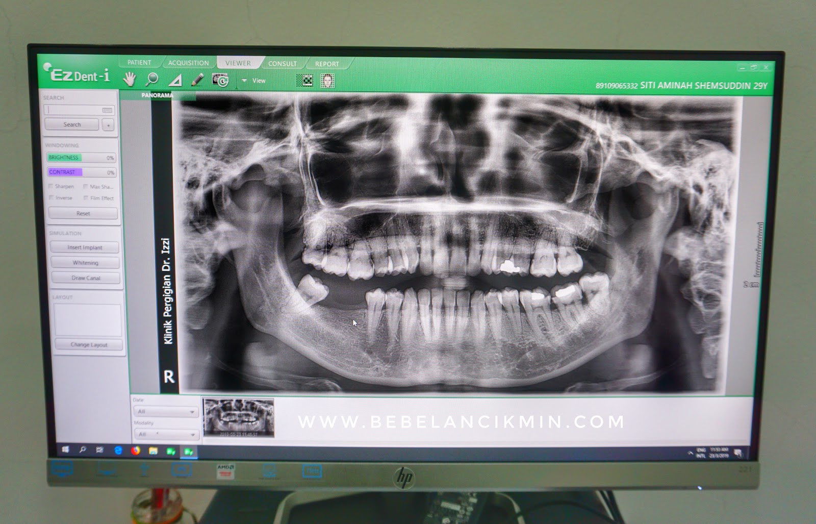 Rawatan Pergigian Seawal Usia 6 Bulan Di Klinik Pergigian Dr Izzi