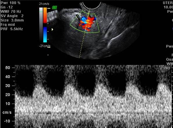 AVM IN CESAREAN SCAR-USG - Sumer's Radiology Blog
