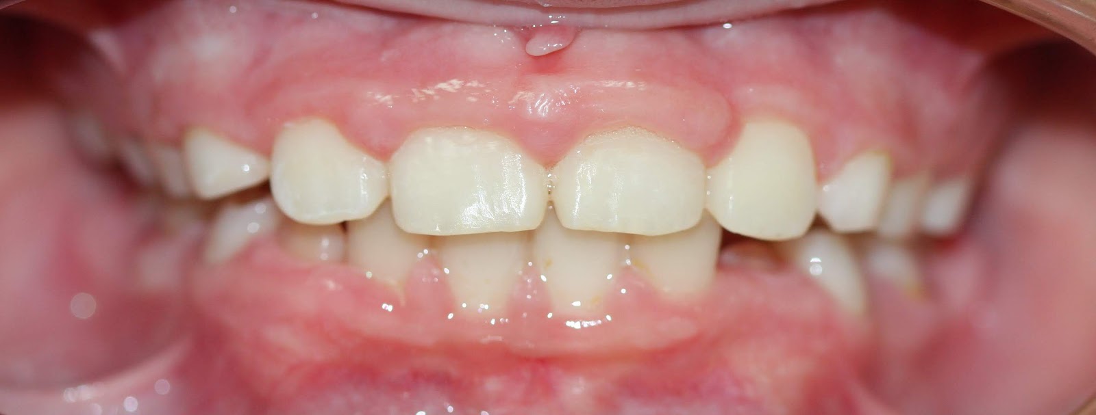 James R. Waters, DDS, MSD, PA: Closing space between upper teeth (and ...