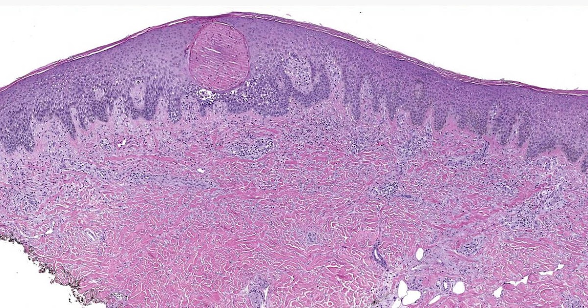 VIRTUAL GRAND ROUNDS IN DERMATOLOGY 2.0: DPP4-Inhibitor Drug-Induced ...