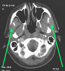 Radiologist For Ever: Parapharyngeal space rule 1:Anatomy and pathology