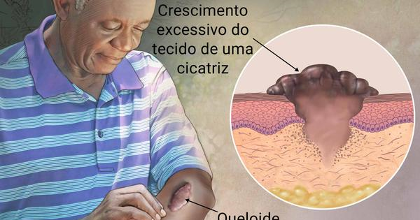 Milaribeiro: Queloide