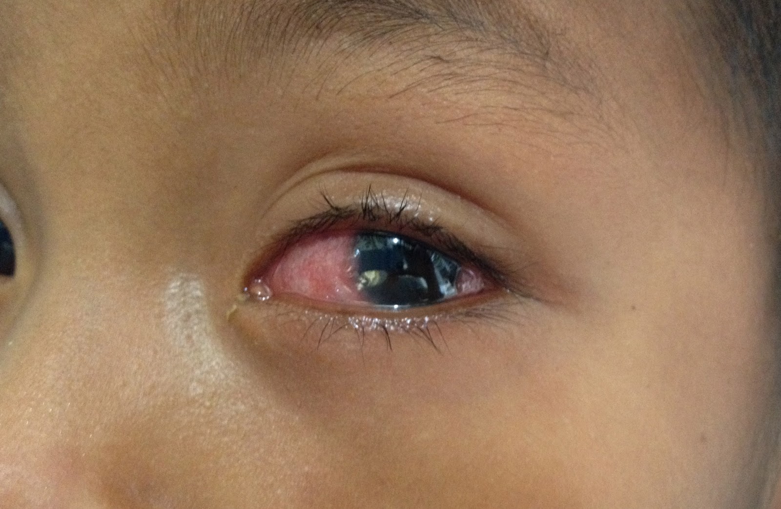 Santa Clotilde Mission, Peru: Phlyctenulosis