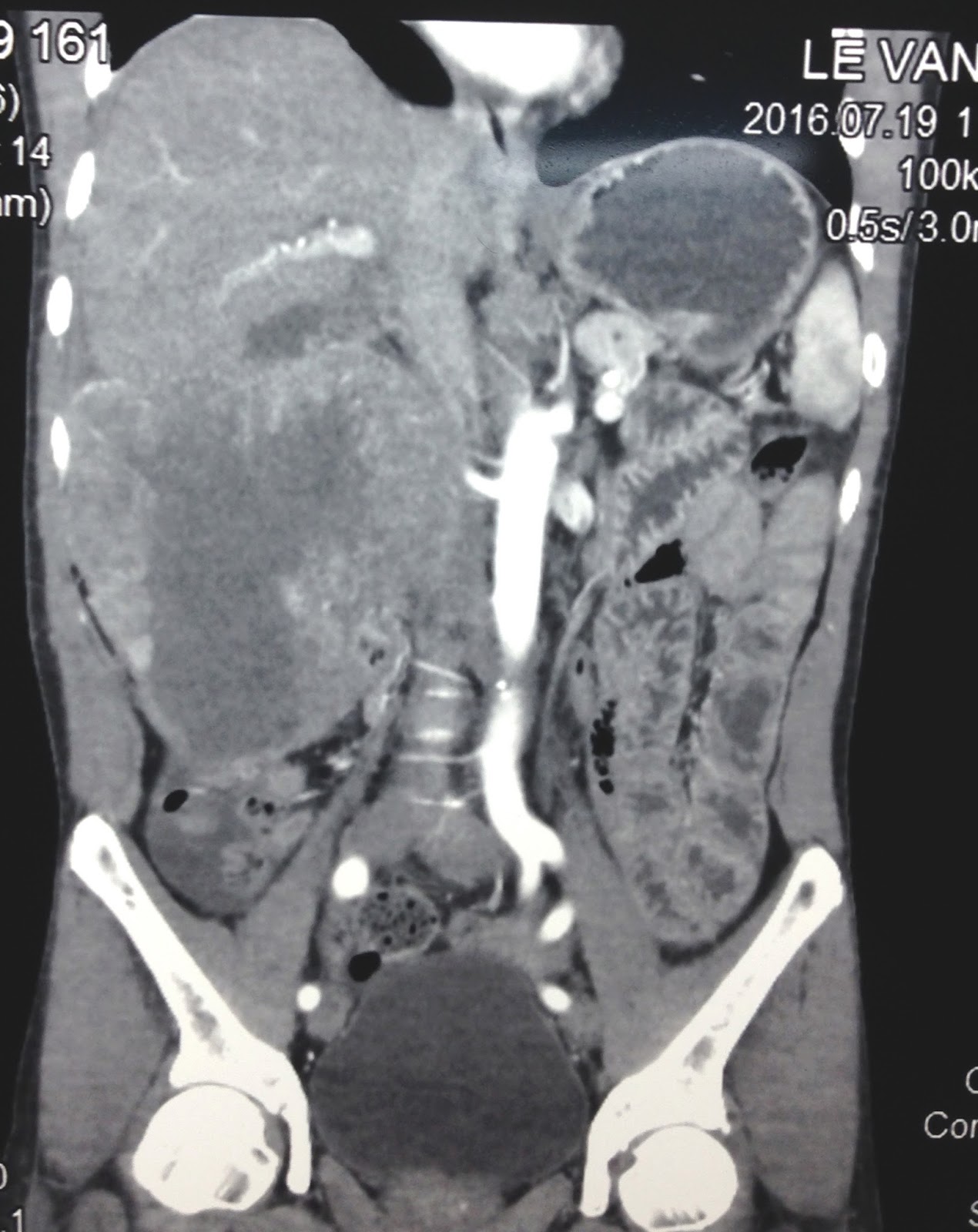 VIETNAMESE MEDIC ULTRASOUND: CASE 390: PEDUNCULATED HCC, Dr PHAN THANH ...