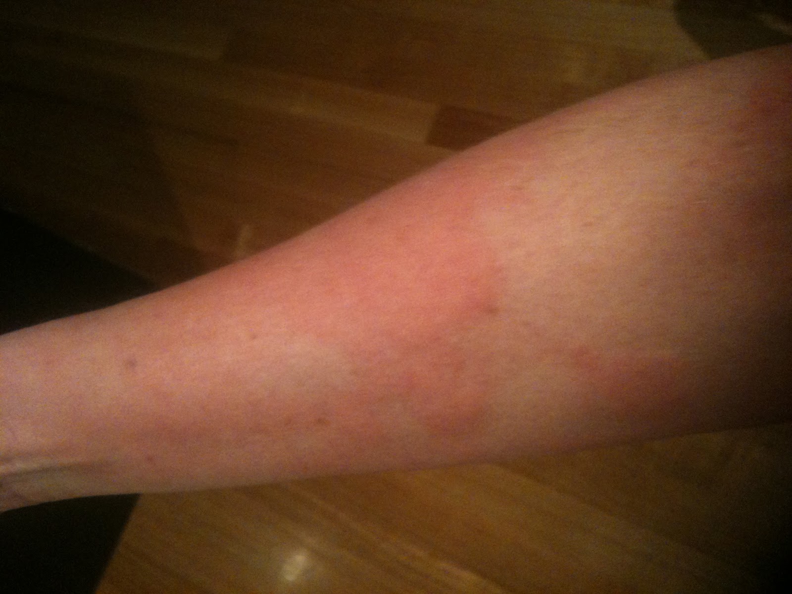 Topical Steroid Withdrawal Journey-Healing Eczema and Red Skin Syndrome ...