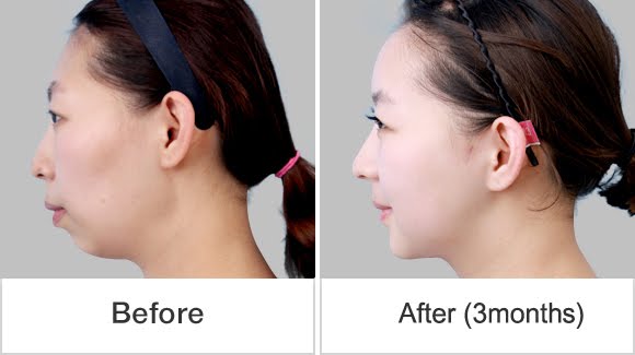[Real Story] Korean Two Jaw Surgery & Cheekbone Reduction for Younger ...