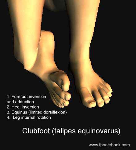 Physical Therapy Exercises: club foot