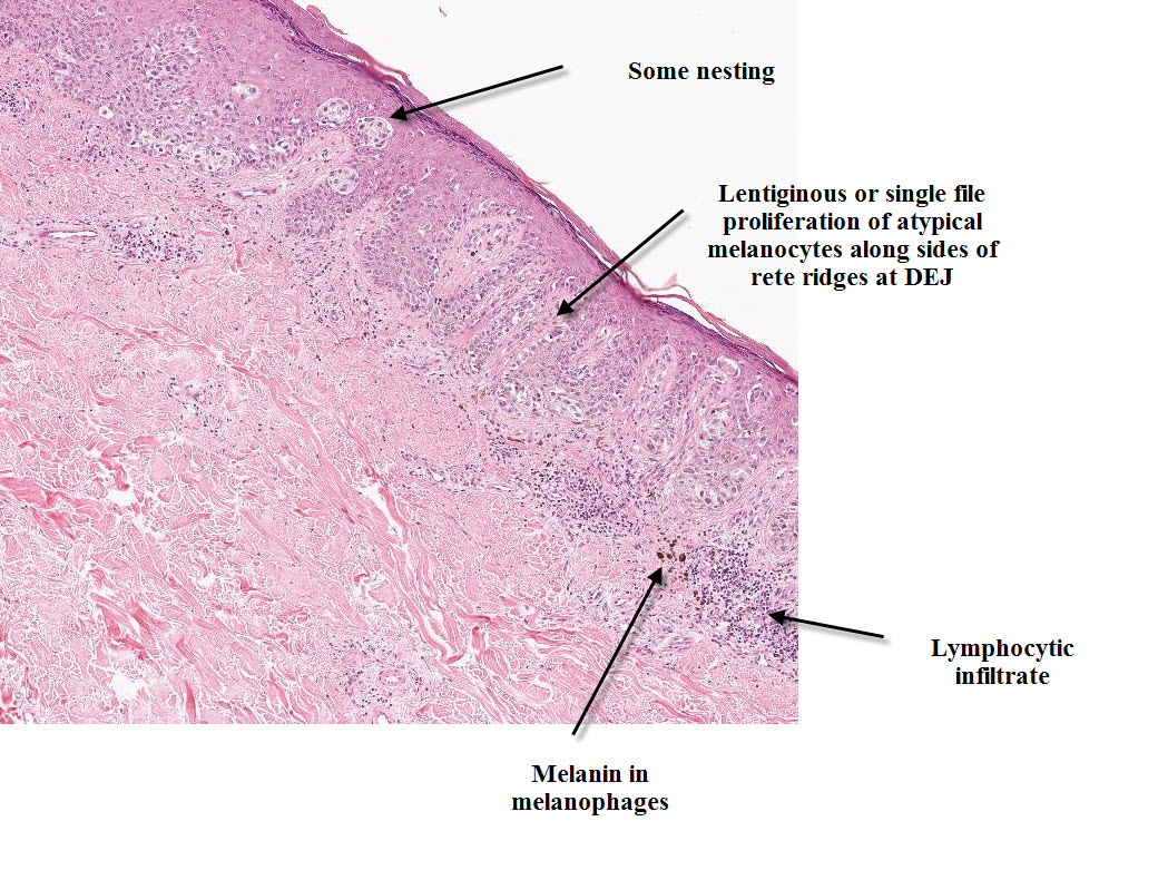 Dermpath Made Simple - Neoplastic: Lentigo Maligna