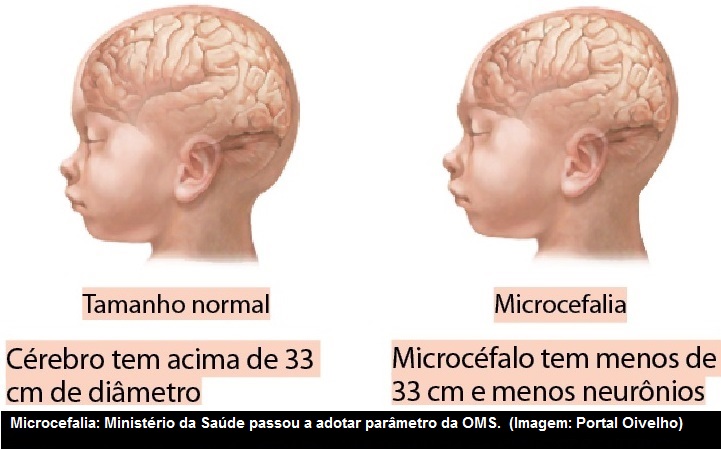 Blognetto: Microcefalia: Ministério da Saúde passa a adotar valor de 32 ...