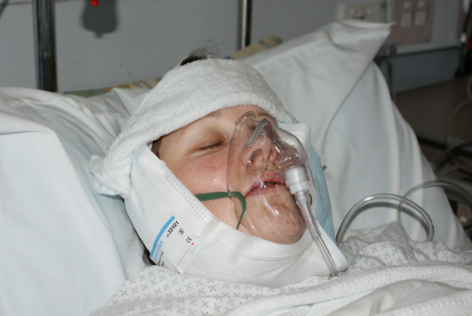 Braces + SARPE/SARME Surgery