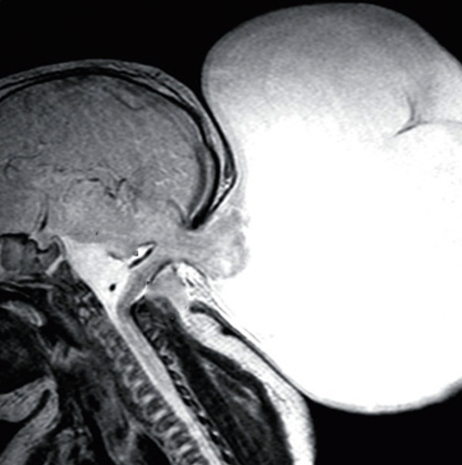 Chiari 3 Malformation