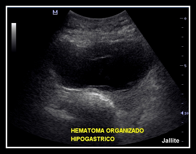 Hematoma Post-Cesarea