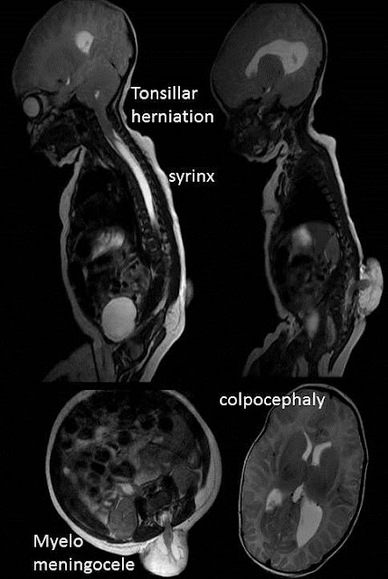 Radshare: ARNOLD CHIARI TYPE II MALFORMATION